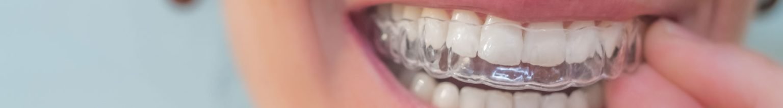 Clear Braces Huddersfield - Transparent Braces Halifax